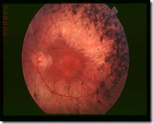 Global Eye Clinic: Know And Treat Your Eye Problems: Retinitis ...